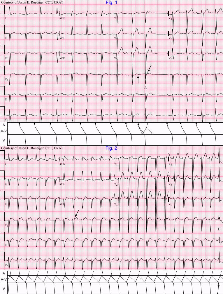 Left Axis Deviation Ecg Guru Instructor Resources